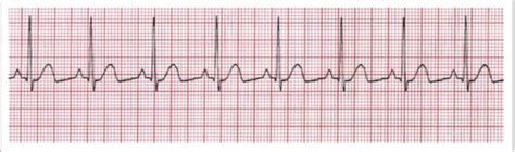 Ecg Lab Cases Flashcards Quizlet