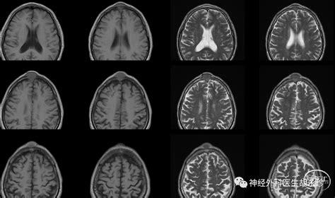 颅骨肿瘤，是什么性质？ 脑医汇