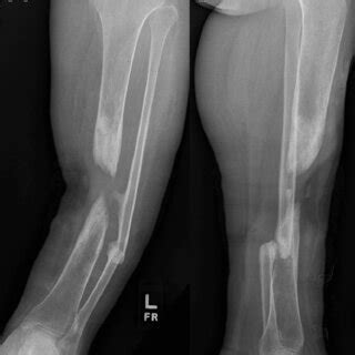 A Anteroposterior And B Lateral Radiographs Of A Left Tibia Download Scientific Diagram