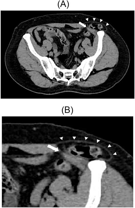 Contrast Enhanced Ct Scan The Sigmoid Colon Entered Into The Layer Download Scientific Diagram