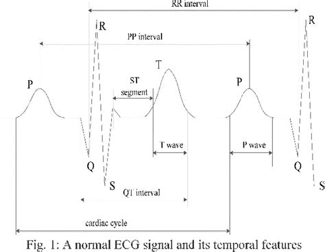 Figure 1 From The Qrs Complex Detection Of Ecg Signal Based On Ipcmm Algorithm Semantic Scholar