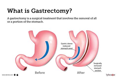 Total Gastrectomy