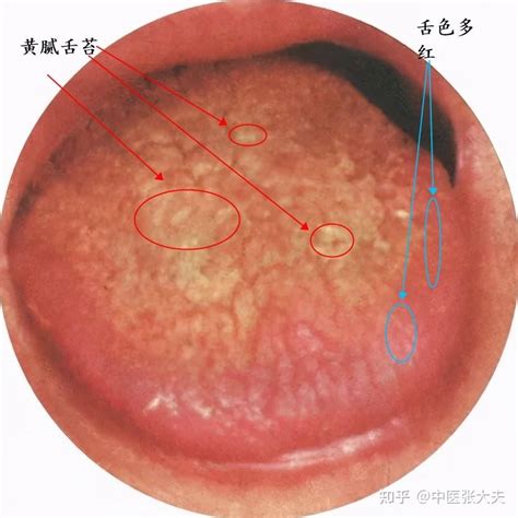 痰湿寒湿湿热三者舌苔的区别 知乎