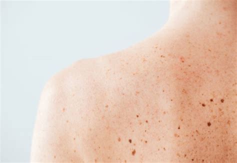Коричневые пятна на теле почему могут быть на лице руках и ногах у