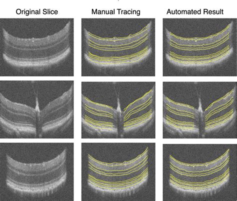 Figure 1 From Automated 3d Segmentation Of Intraretinal Surfaces In Sd