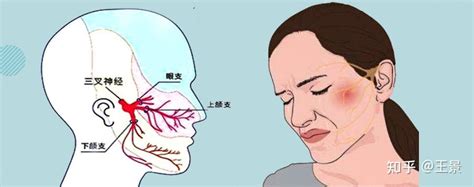 面部哪里疼是三叉神经痛治疗方法如何选择 知乎