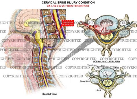 C4 5 C5 6 C6 7 Cervical Disc Herniations 3 Level — Medical Art Works