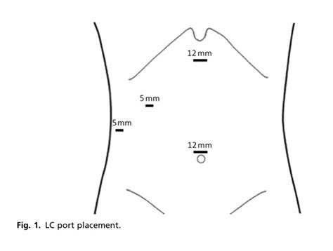 Laparoscopic Cholecystectomy Trocar Placement Techniques Of