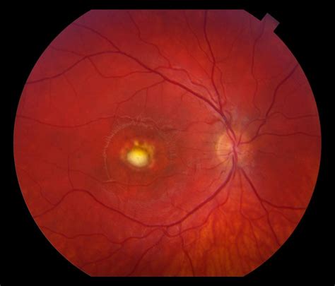 Moran Core Fundus Photo And Oct Of Bests Vitelliform Macular Dystrophy Bvmd