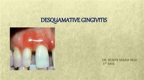 Desquamative Gingivitis Pptx