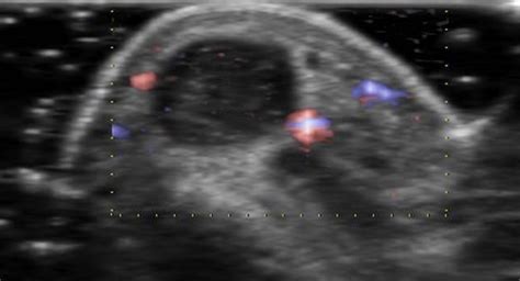 Musculoskeletal Joints And Tendons 64 Fingers Case 645 Tumors Ultrasound Cases