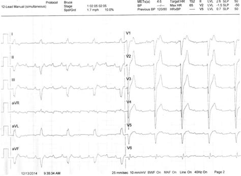 Trifascicular Block Progressing To Complete Av Block On Exercise A Rare Presentation