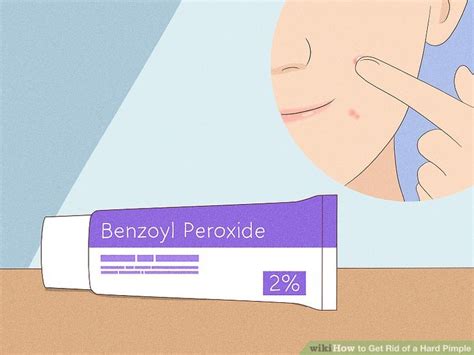 3 Ways To Get Rid Of A Hard Pimple WikiHow