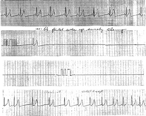 Sinus Node Function Thoracic Key