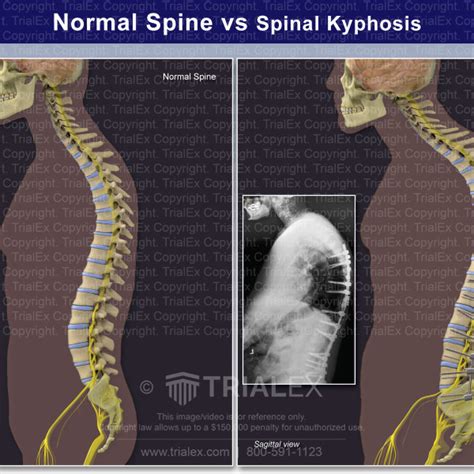 Normal Spine Vs Spinal Kyphosis Trial Exhibits Inc