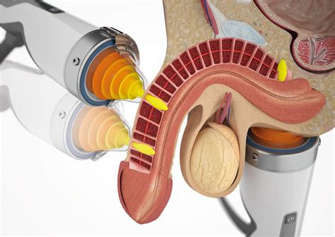 Penile Stimulation Therapy