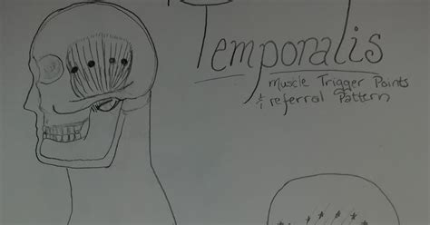 Trigger Point Temporalis