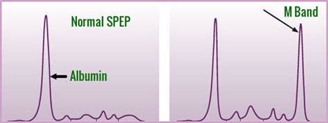 Multiple Myeloma Ask Hematologist Understand Hematology