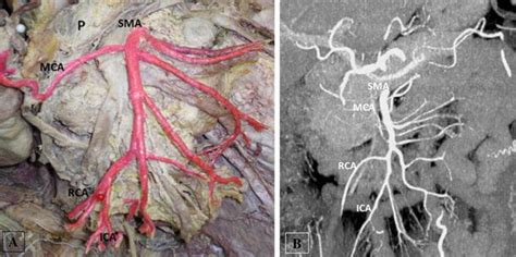 Pattern Iib Right Colic Artery And Ileocolic Artery Arises In A