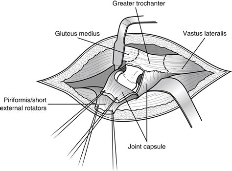 Hip Arthroplasty Via Small Incision Enhanced Posterior Soft Tissue Repair Musculoskeletal Key