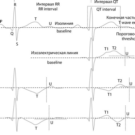 QT Interval Estimation With Threshold Method Download Scientific Diagram