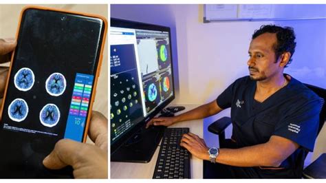Nuh Uses Ai Tool For Faster Treatment Of Stroke Patients