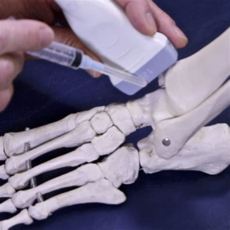 Ankle Tibiotalar Joint Injection Protocol Msk Ultrasound Training Llc Ankle Tibiotalar Joint Injection Protocol Msk Ultrasound Training Llc