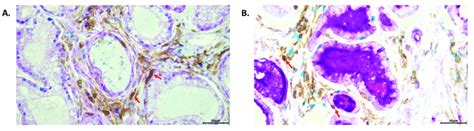 Prostate Cancer Tumor Immune Microenvironment Multiplex Download