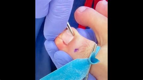 Bilateral Matrixectomy Youtube