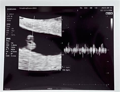 다시 임신 6주차 계류유산 후 재임신 본격 입덧 시작 ⭐️첫 심장소리⭐️ 네이버 블로그