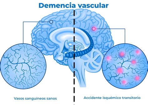 Demencia Vascular Centro Médico Abc