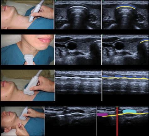 Ultrasonographic Identification Of The Cricothyroid Membrane Best