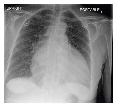 Upright Ap Cxr Obtained On Admission Shows Markedly Enlarged Cardiac