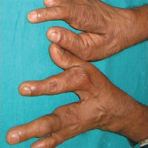 Hands With Syndactyly Clinodactyly And Ectrodactyly Of Female Patient