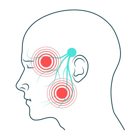 Facial Neuralgia Symptoms Causes And Treatment