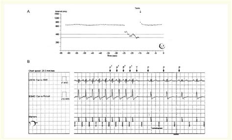Example Of Intrathoracic Electrograms Of Atrial Tachycardia A A Flow
