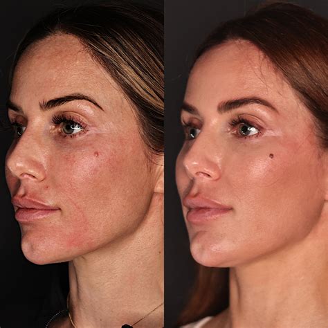 Bbl Laser Before And After Kaado Md Aesthetics And Anti Aging Medicine