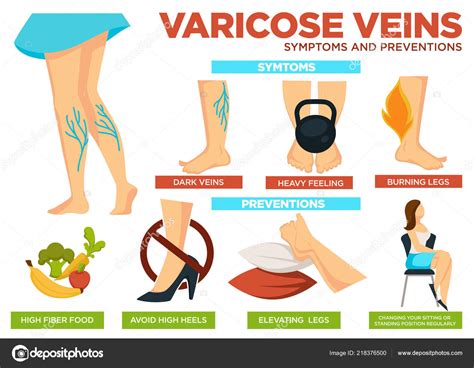 Varicose Veins Symptoms And Preventions Poster Vector Image My Xxx Hot Girl