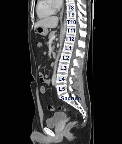 Sagittal Ct Lumbar Spine Anatomy Radiology Anatomy Spines