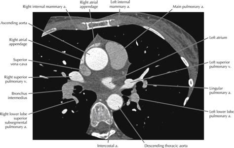 Cardiac Anatomy Using Ct Radiology Key