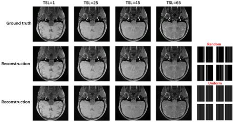 Sampling Generation Results Of Tsl Weighted Images With Different Download Scientific Diagram