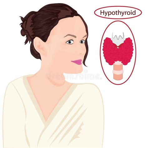 Comparison And Difference Between Hyperthyroidism And Hypothyroidism