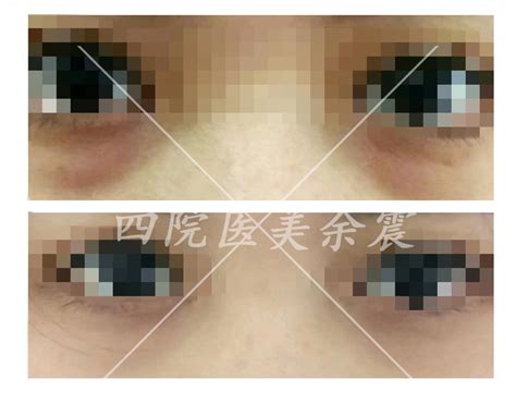 熊猫针？能帮助我的泪沟凹陷吗？ 知乎
