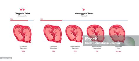 자궁 의학 다이어그램에서 배아 벡터 플랫 헬스케어 일러스트레이션 위치 동안 자궁에서 쌍둥이의 태반 단조롭고 이질적인 아기 건강 관리 교육을위한 디자인 태반에 대한 스톡 벡터