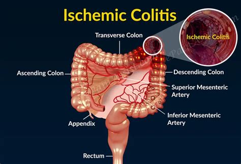 How Serious Is Ischemic Colitis Corpus Magazine
