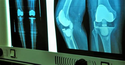 Oral Antibiotics ‘as Good As Iv Antibiotics For Periprosthetic Joint