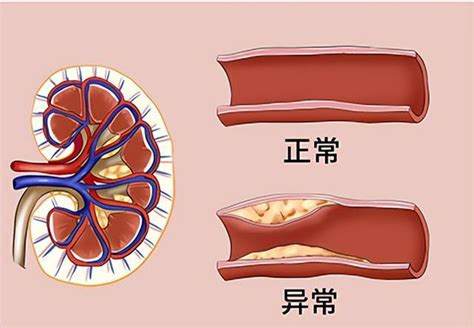 肾动脉狭窄的治疗措施有哪些 科普文章 健康科普 就医版 山东第一医科大学第一附属医院山东省千佛山医院官方网站