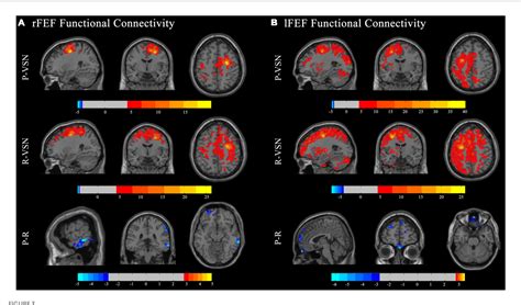 Table 1 From Neural Substrates In Patients With Visual Spatial Neglect