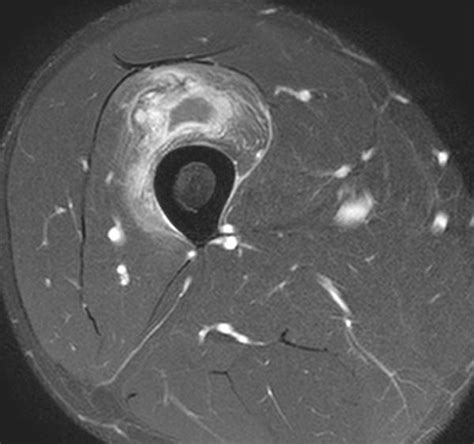 Myositis Ossificans Radsource