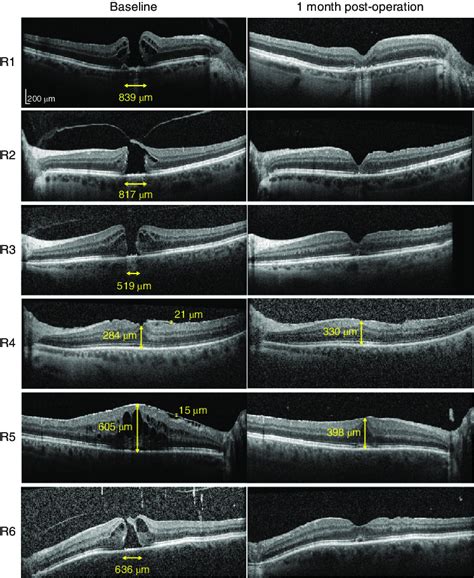 Pre Operative And Post Operative Oct Spectral Domain Oct Scans